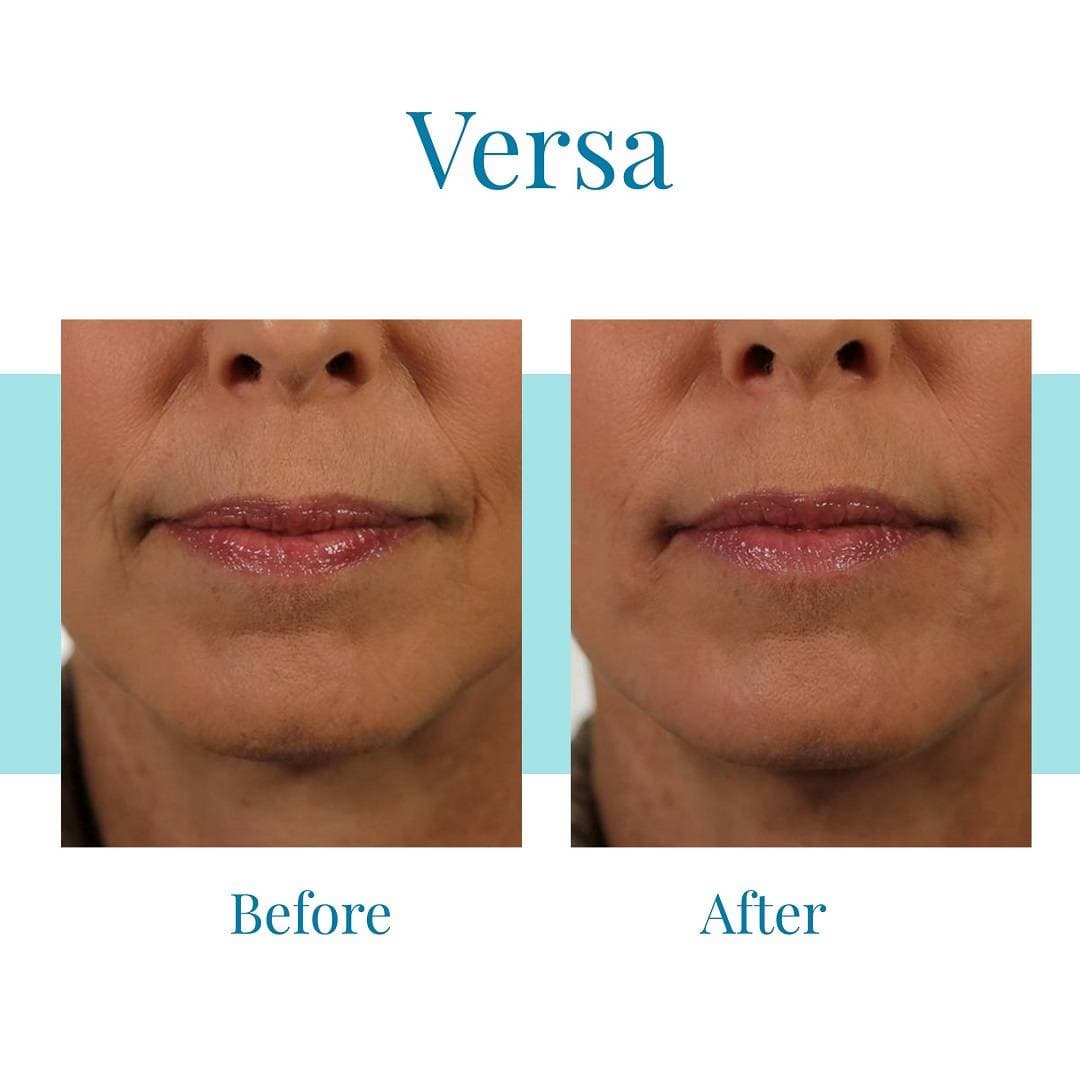 Best Versa Treatment in Buckhead and Alpharetta - Bella Medspa