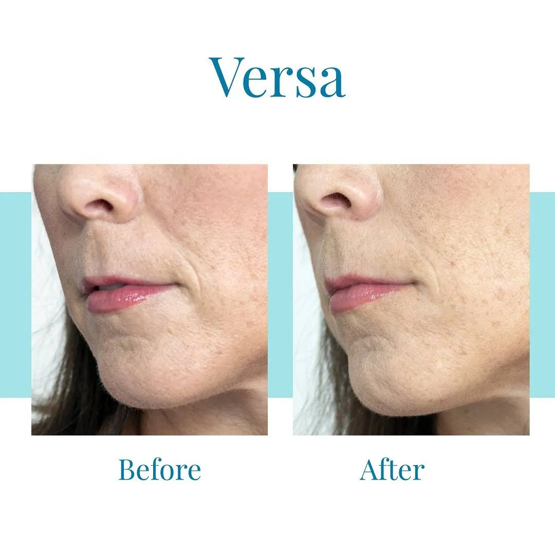 Best Versa Treatment in Buckhead and Alpharetta - Bella Medspa