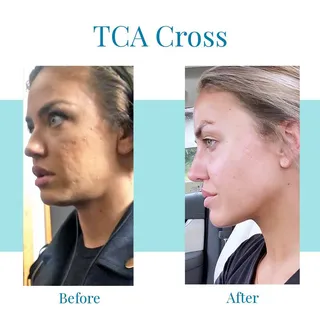 Bella TCA Cross - Bella Medspa